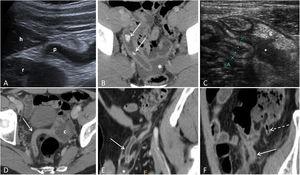 Actualización de la apendicitis aguda: hallazgos típicos y atípicos ...