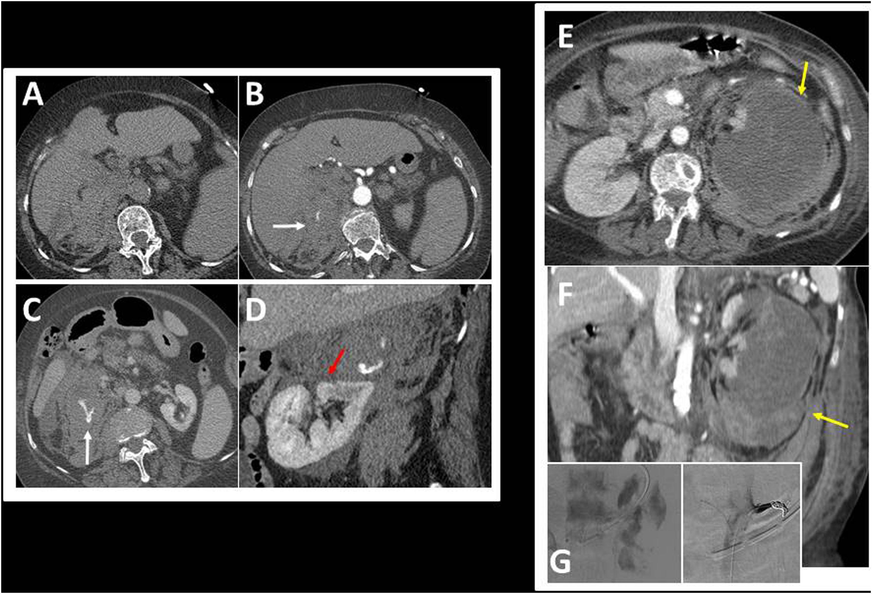 Hemorragia abdominal espontánea no traumática | Radiología