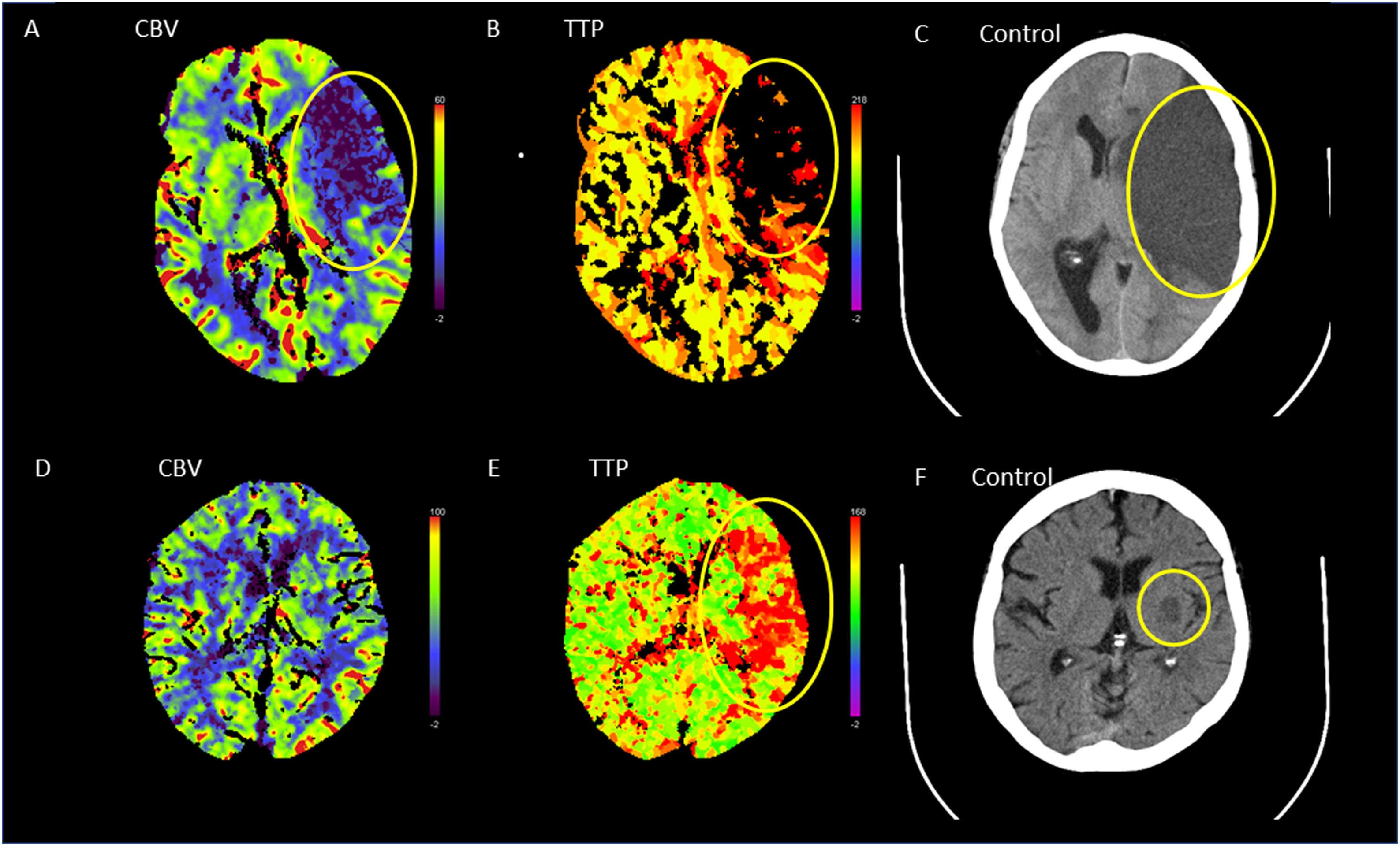Actualización del código ictus en urgencias | Radiología