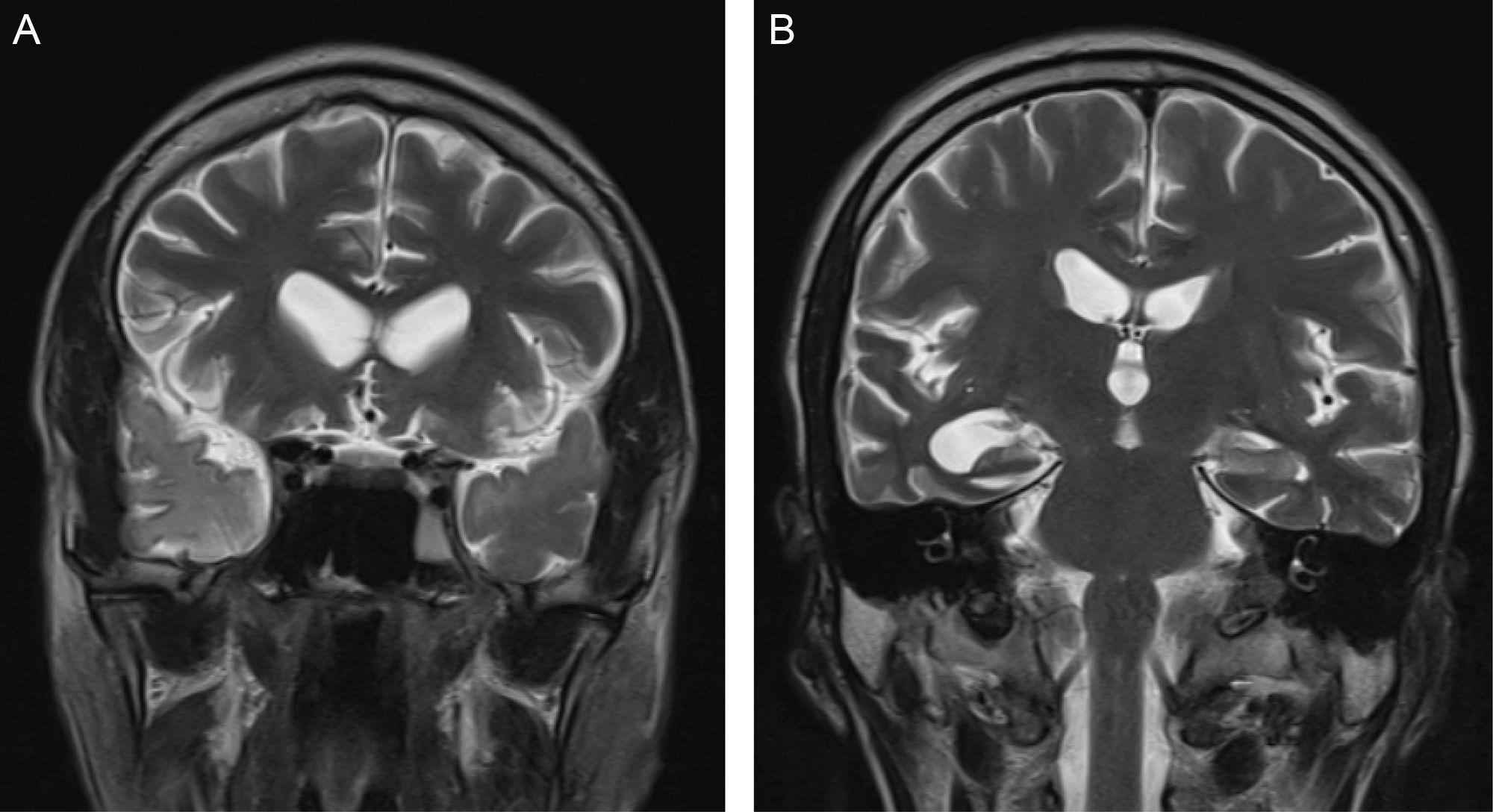 Neurosífilis: un problema antiguo que no pierde actualidad | Revista ...