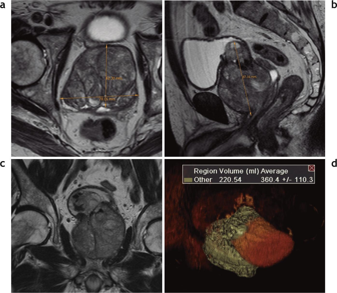 Embolización prostática: un nuevo campo de actuación de la radiología ...