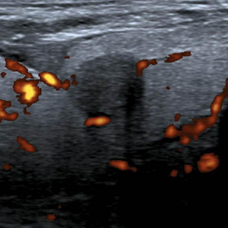 Clasificación TI-RADS de los nódulos tiroideos en base a una escala de ...