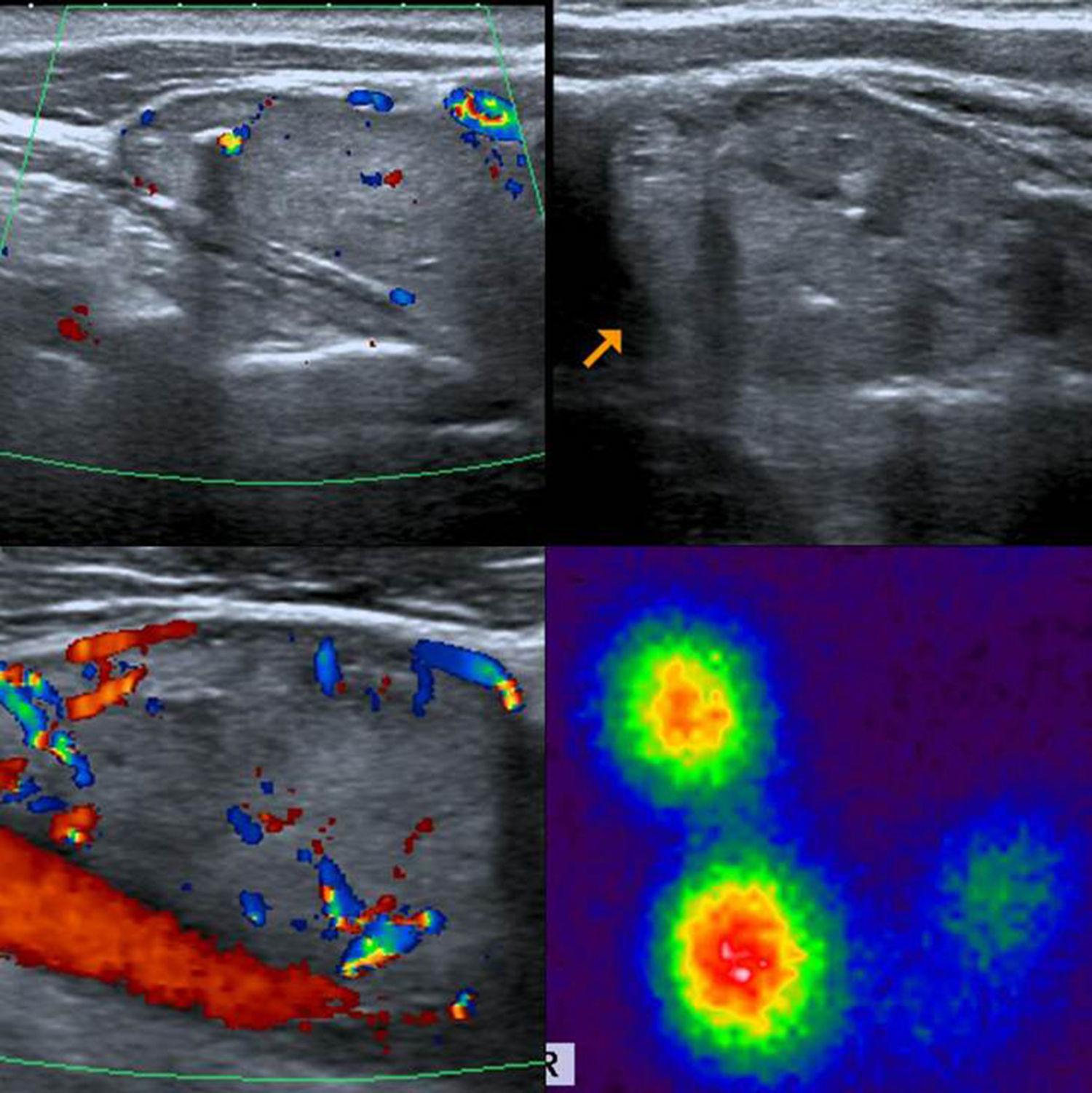 Clasificación TI-RADS de los nódulos tiroideos en base a una escala de ...