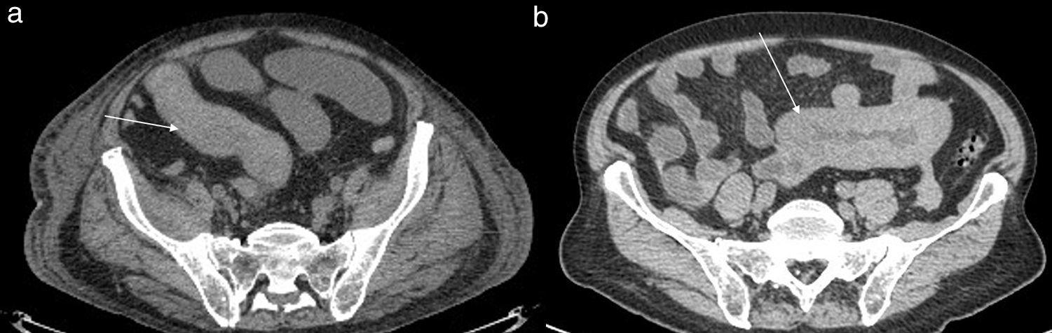 Hallazgos en imágenes del hematoma intramural intestinal espontáneo ...