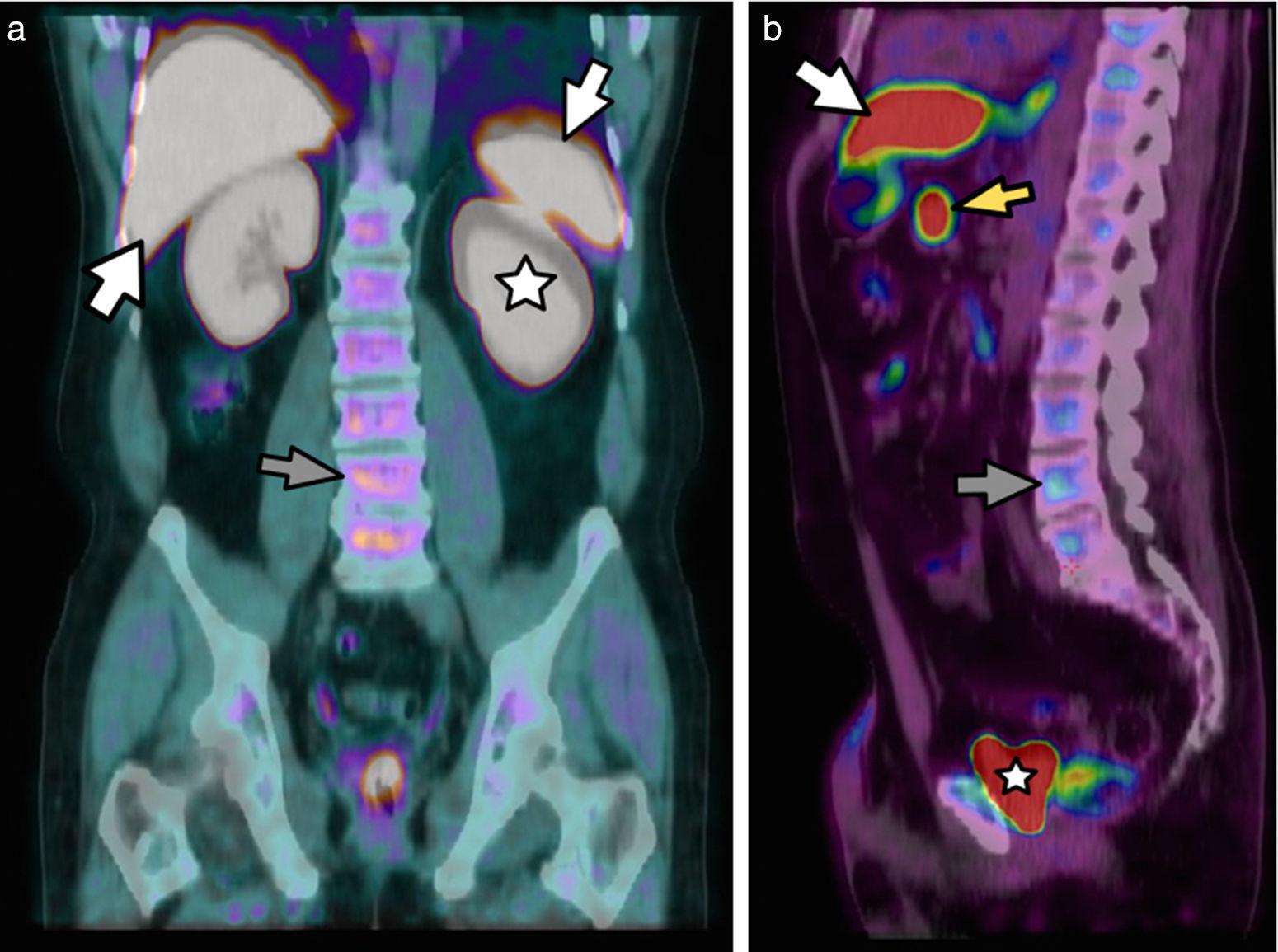 Cáncer de próstata: concordancia entre PET 18F-colina y TC en recaída bioquímica | Revista ...
