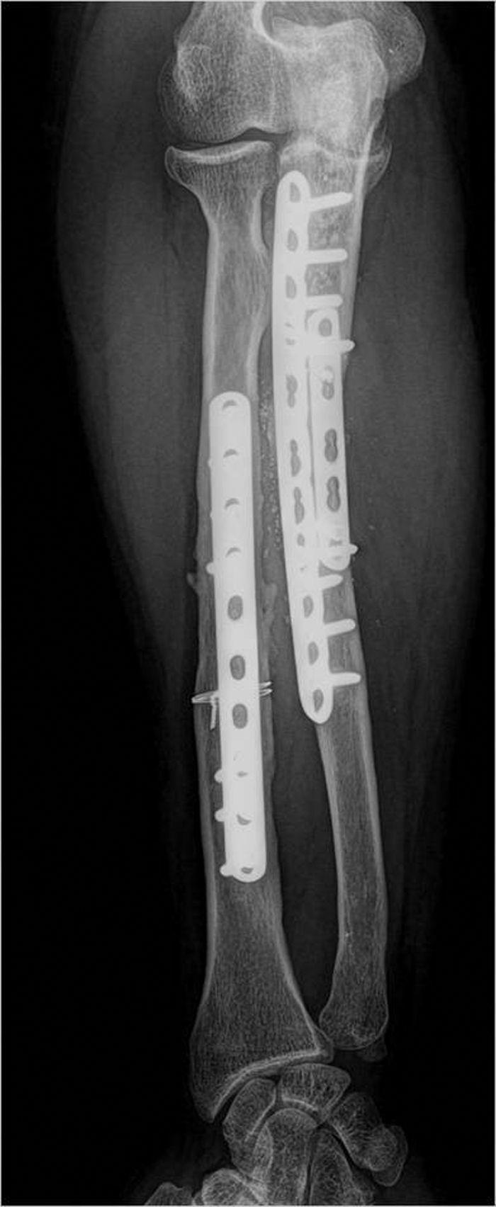 Evaluación radiológica de los elementos de osteosíntesis en el miembro ...