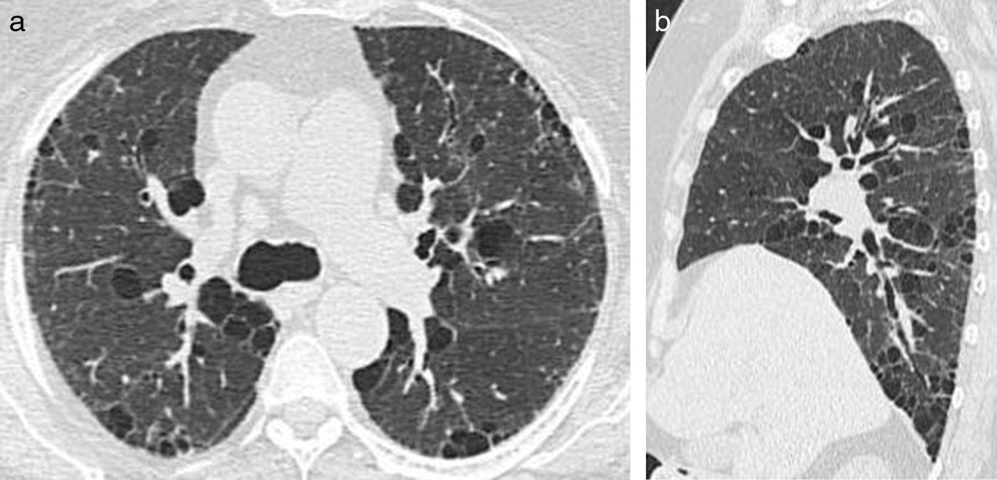 Lesiones pulmonares relacionadas con el tabaquismo. Hallazgos y ...