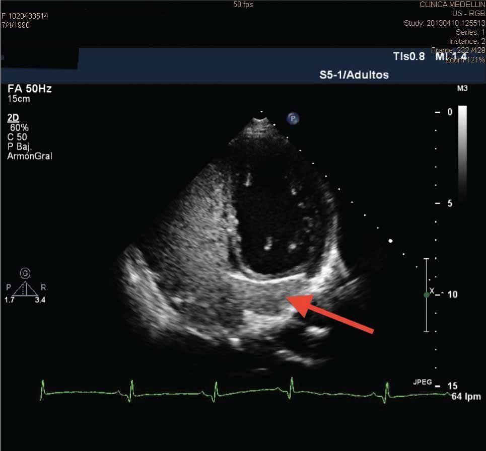 Vena cava superior izquierda persistente | Revista Colombiana de ...