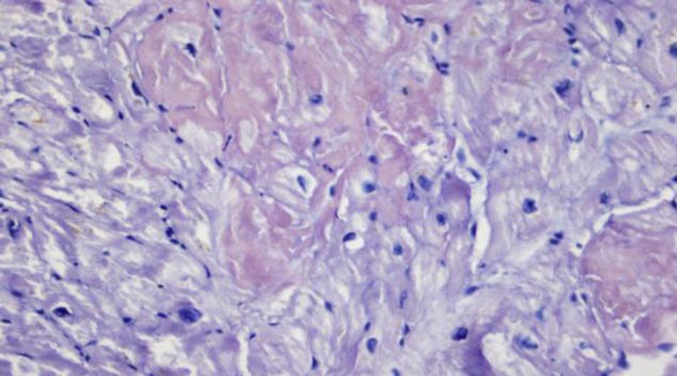 Bloqueo auriculoventricular completo como manifestación de amiloidosis ...