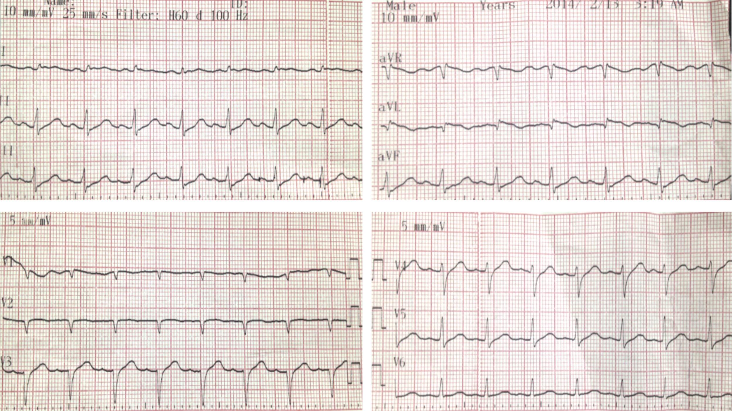 Onda J, predictor de muerte súbita | Revista Colombiana de Cardiología