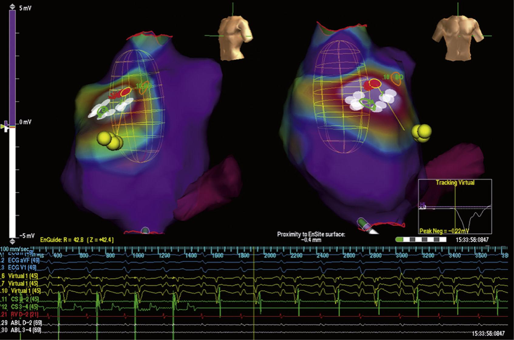 Capítulo 2. Utilidad del mapeo tridimensional en pacientes con ...