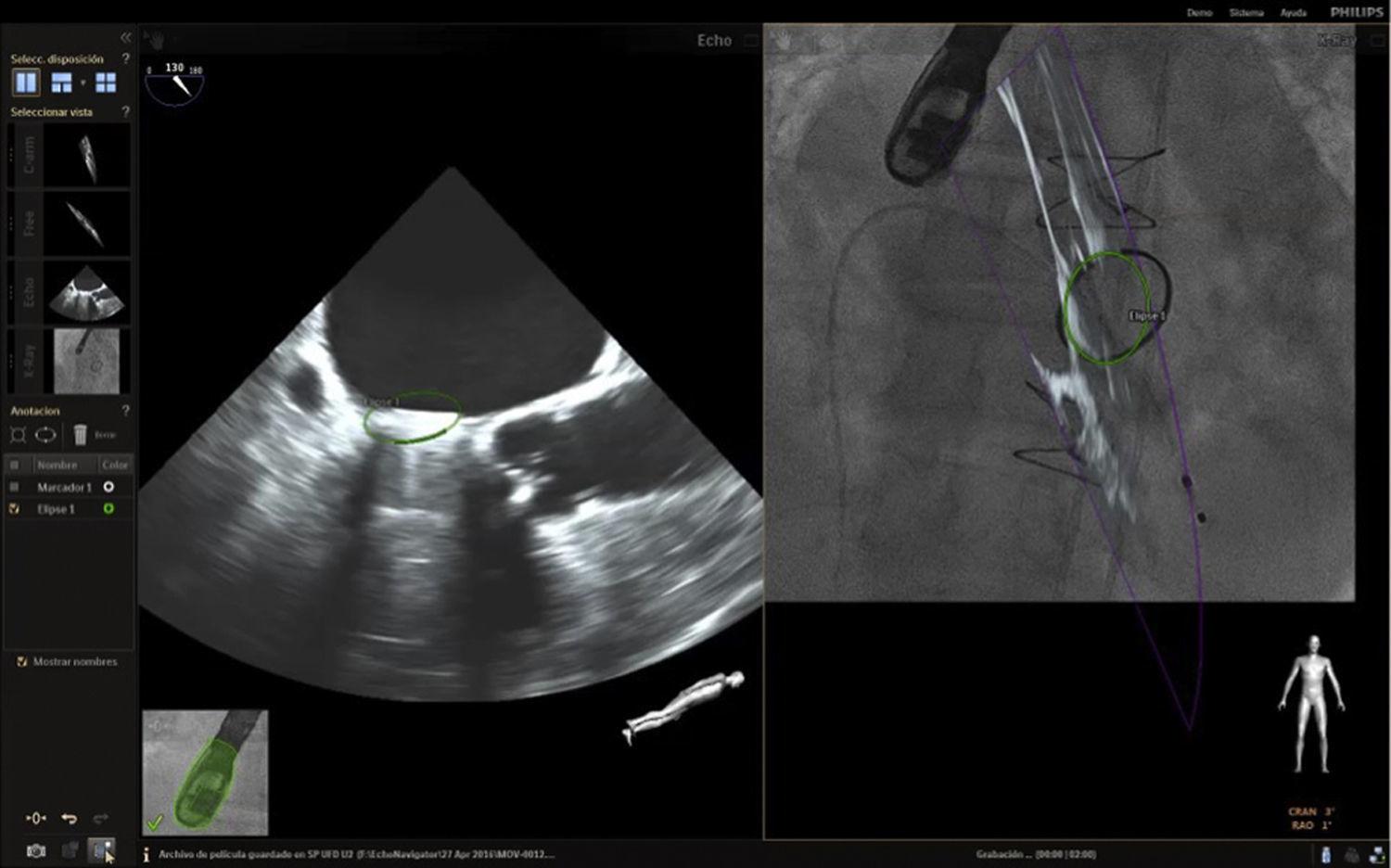 Fusión de ecocardiografía 2D/3D–fluoroscopia: nueva herramienta en el ...