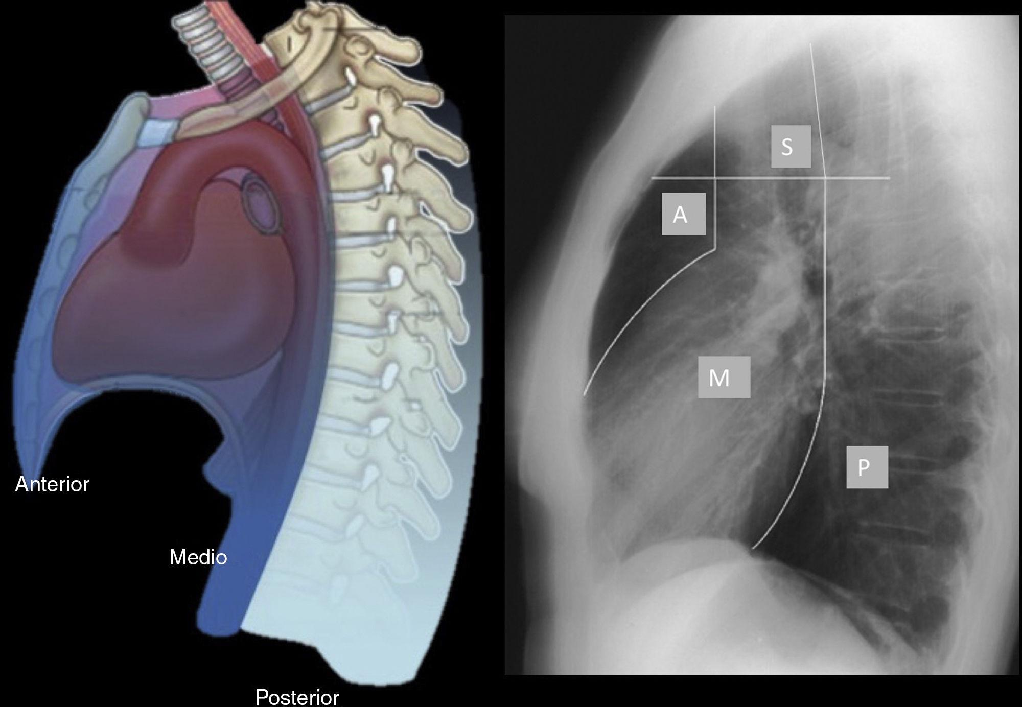 Enfoque inicial de las alteraciones mediastinales: revisión de sus ...