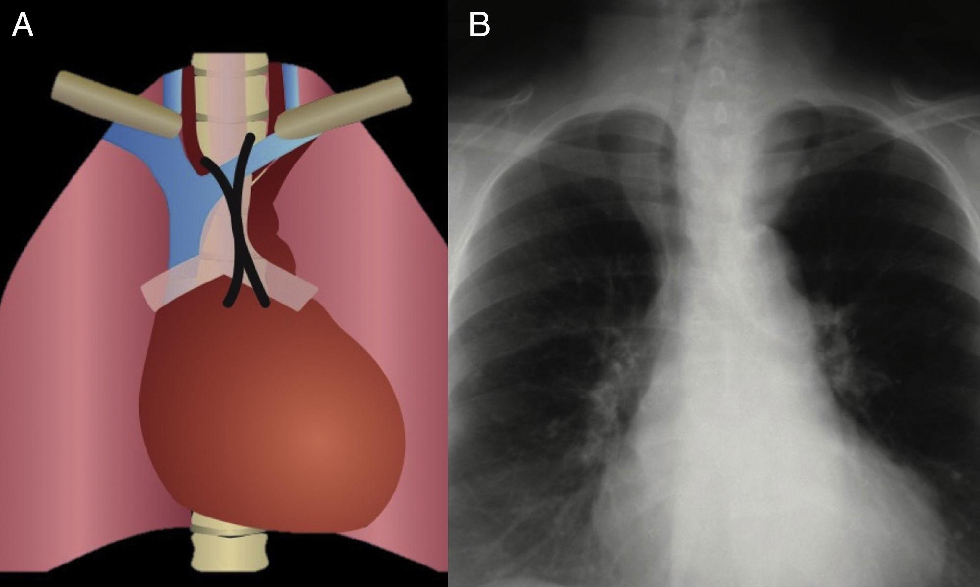 Enfoque inicial de las alteraciones mediastinales: revisión de sus ...