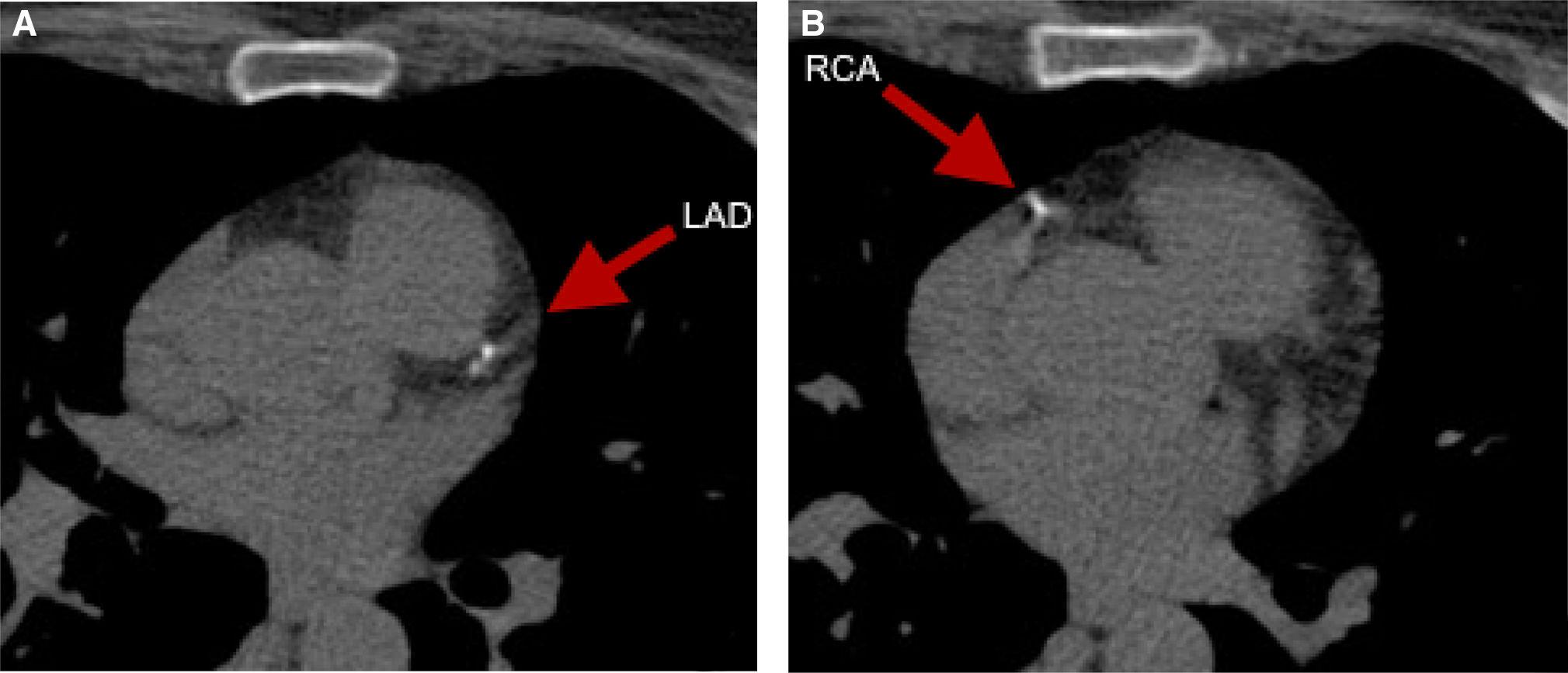 Utility of coronary calcium score in women | Revista Colombiana de ...
