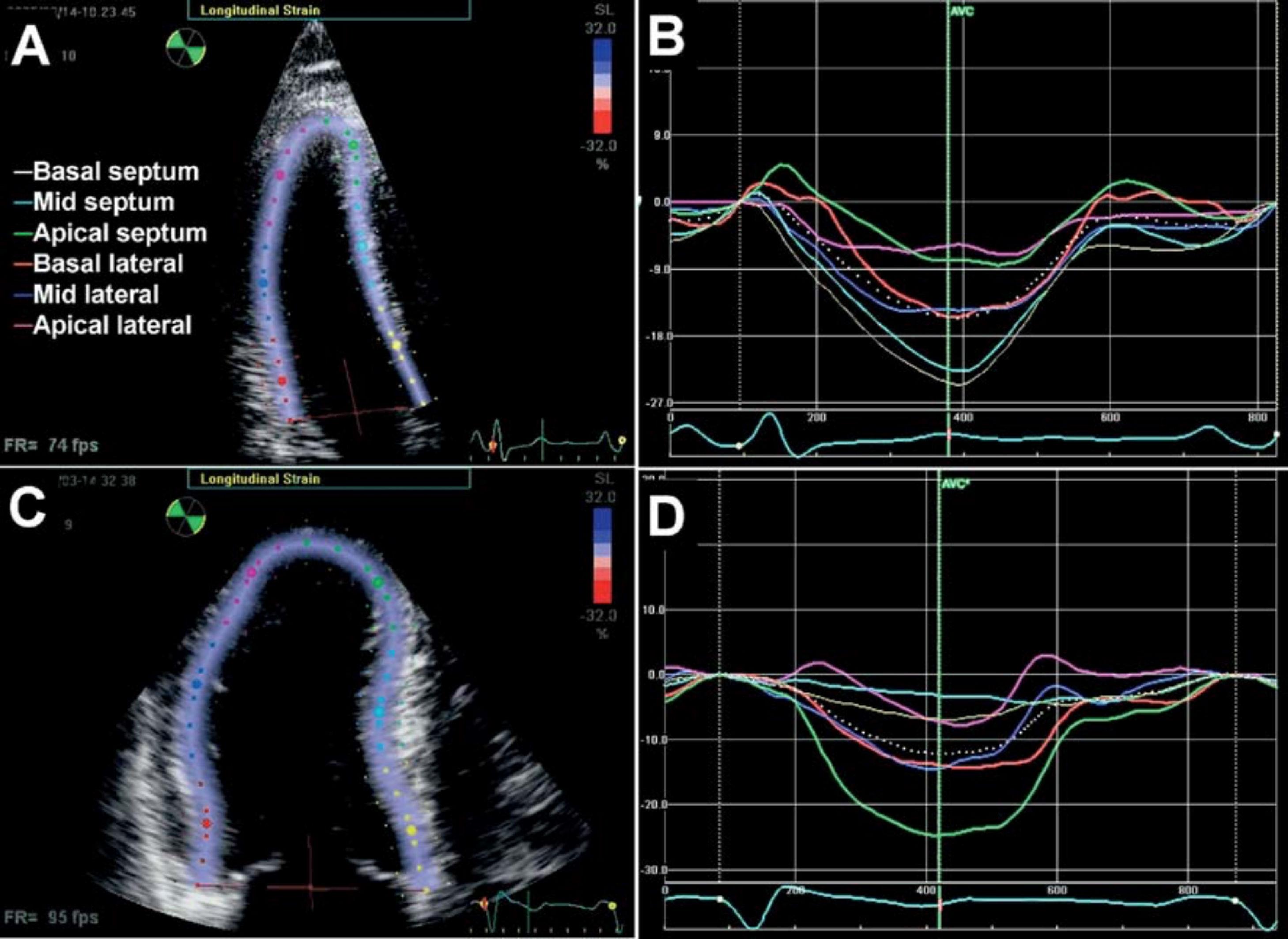 Pericarditis constrictiva: multimodalidad | Revista Colombiana de ...