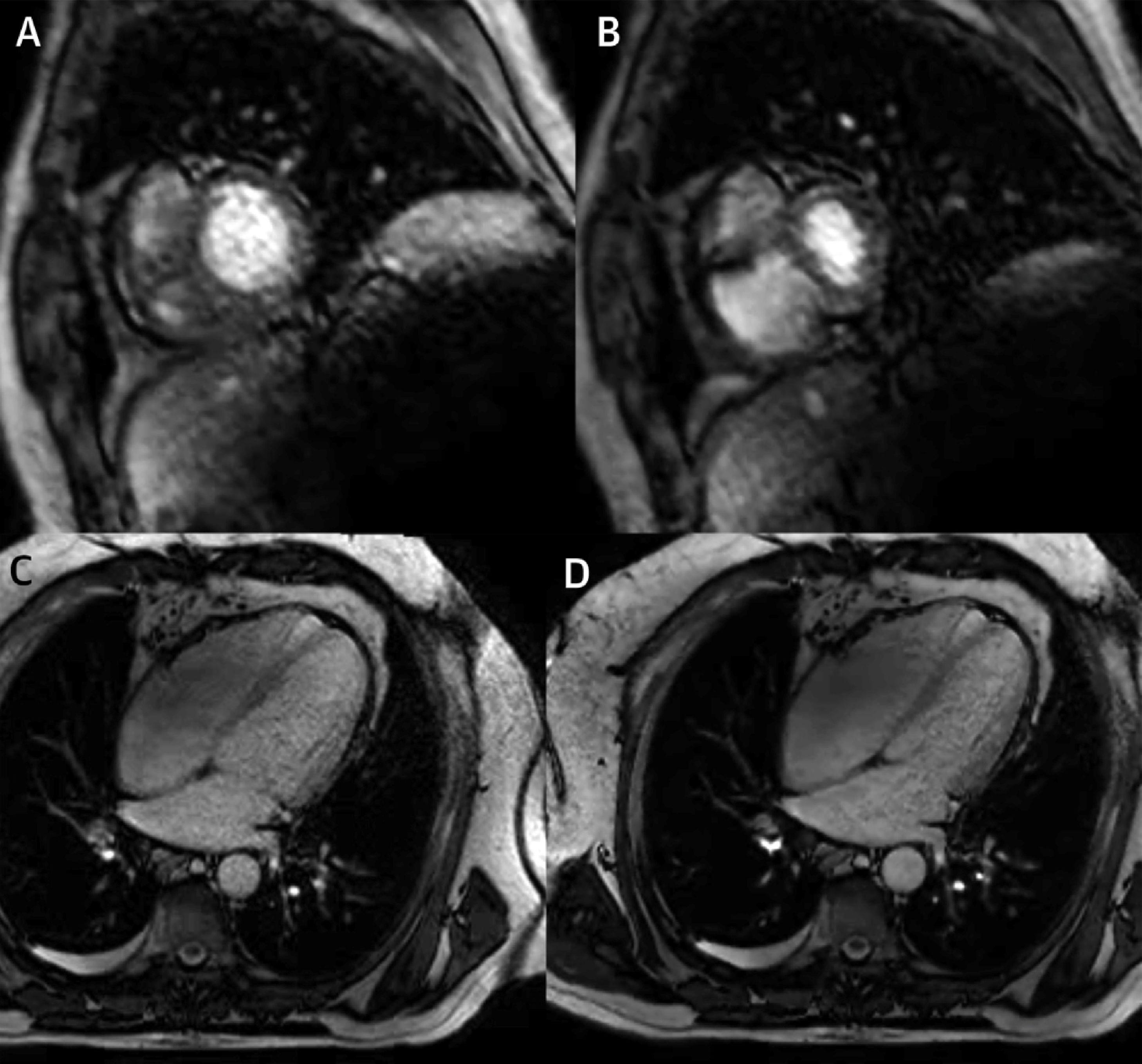 Pericarditis constrictiva: multimodalidad | Revista Colombiana de ...