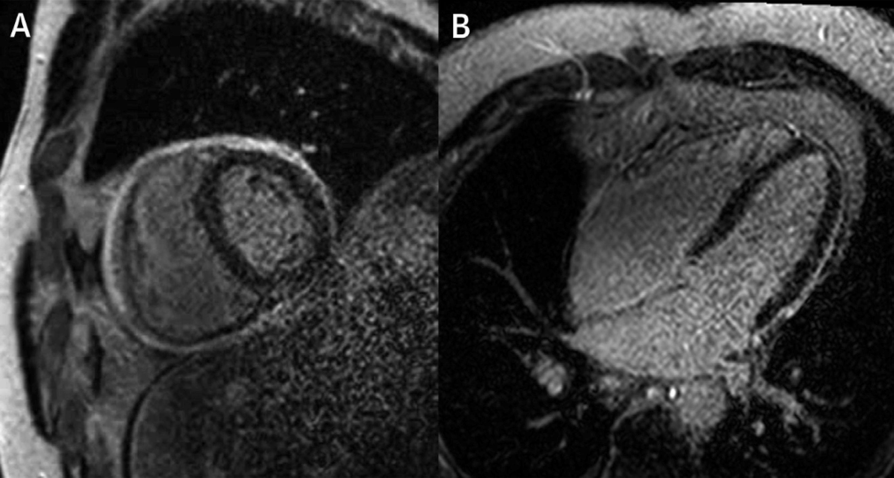 Pericarditis constrictiva: multimodalidad | Revista Colombiana de ...