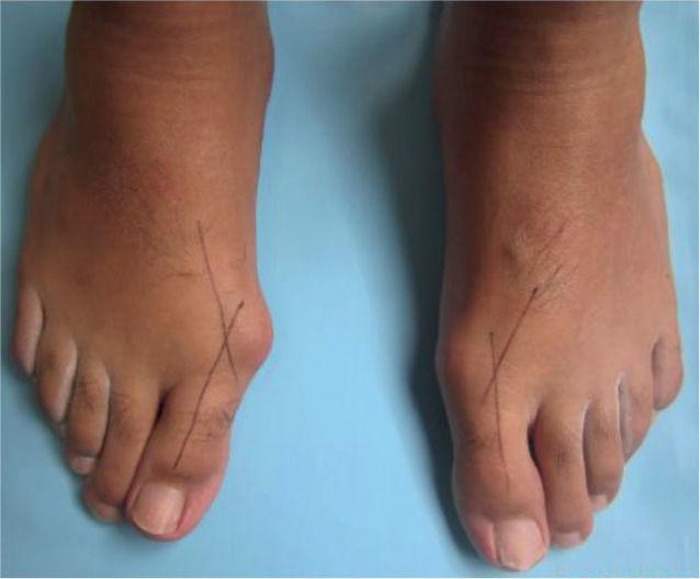 Experiencia con la técnica percutánea mínimamente invasiva para el ...