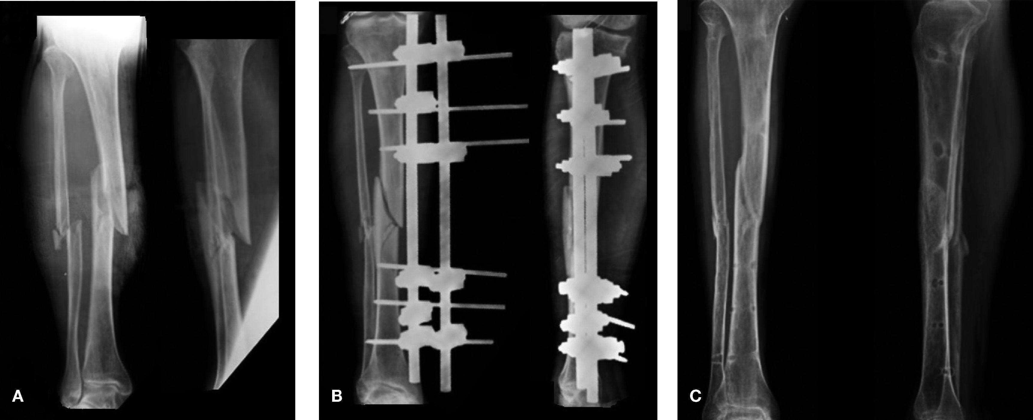 Caracterización de pacientes con fracturas diafisarias expuestas de ...