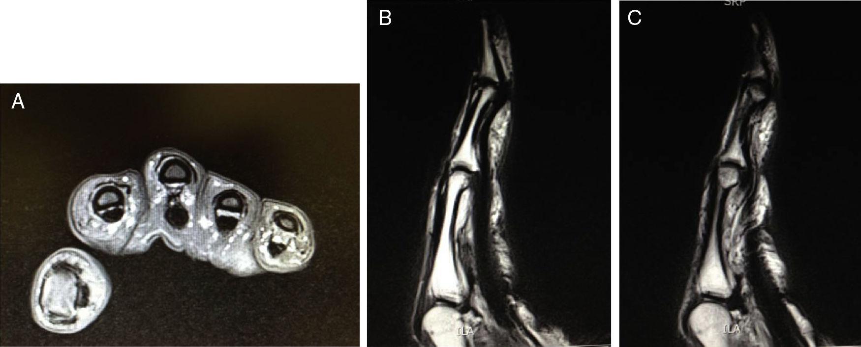 Ruptura de la polea A2 luego de una cirugía para la liberación de dedo ...