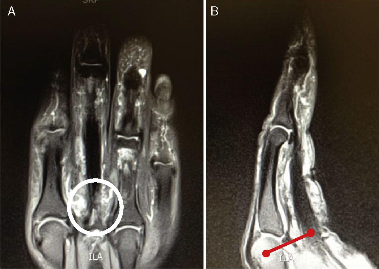 Ruptura de la polea A2 luego de una cirugía para la liberación de dedo ...