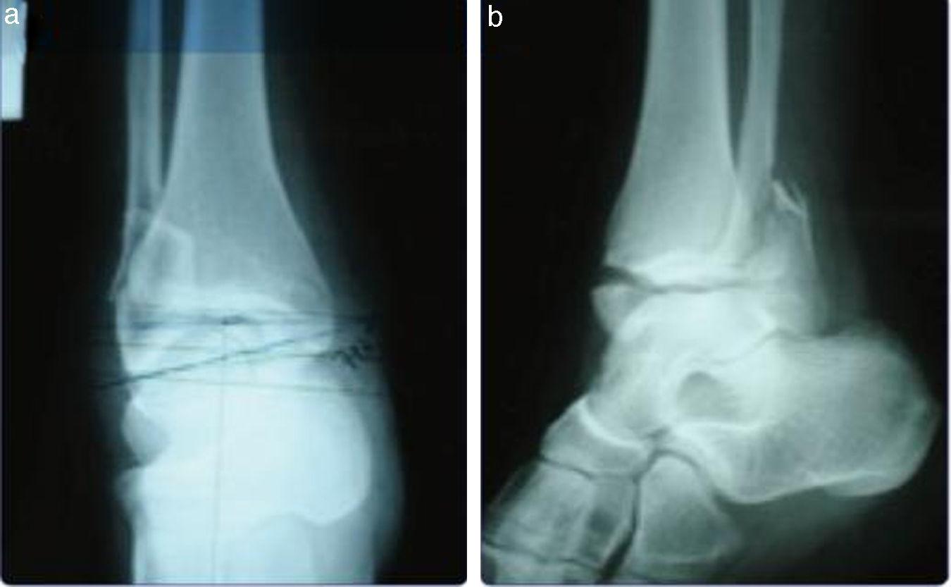 Resultados funcionales de la técnica con placa antideslizante frente a ...