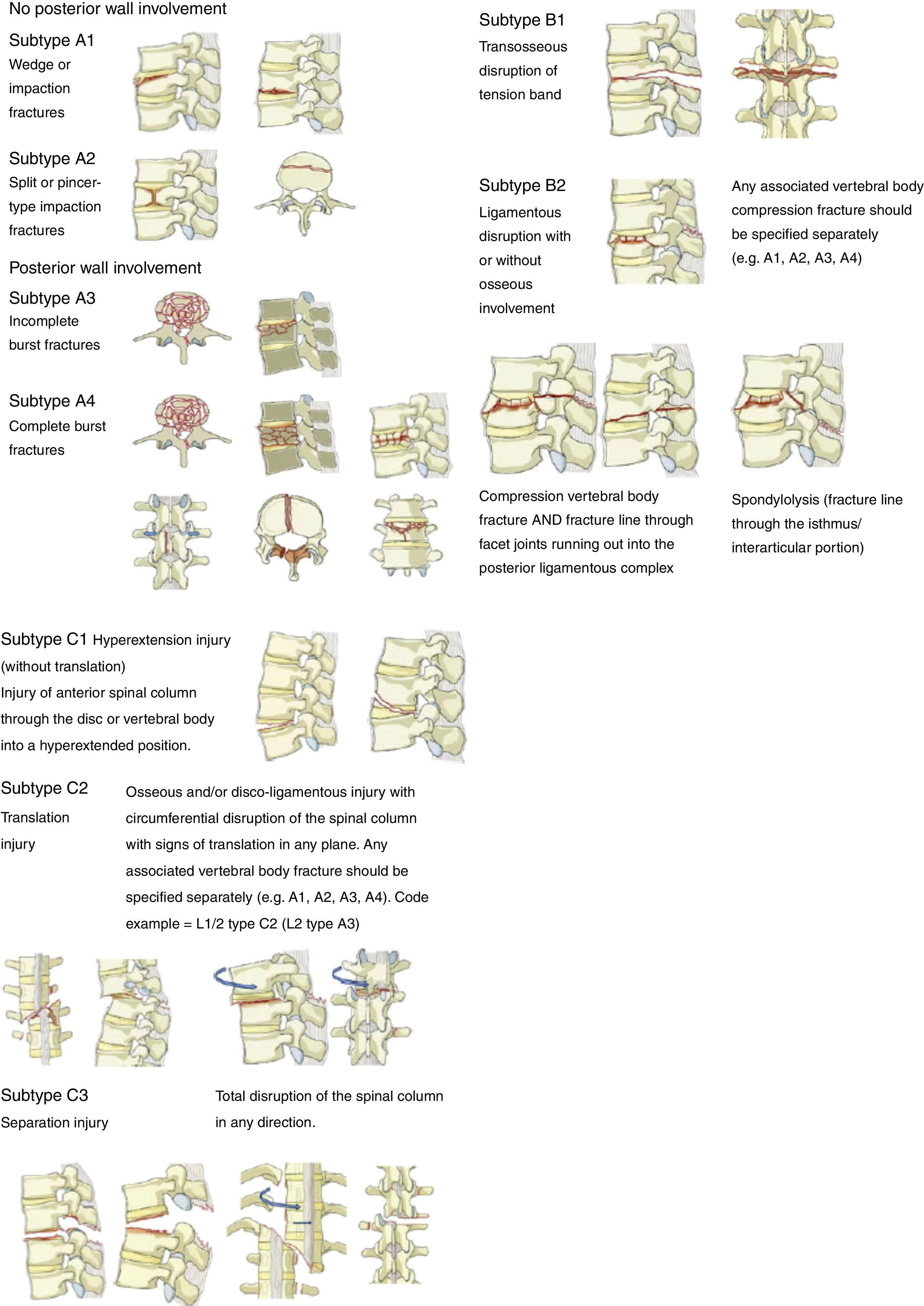 Manejo de las fracturas traumáticas toracolumbares. Serie de casos ...