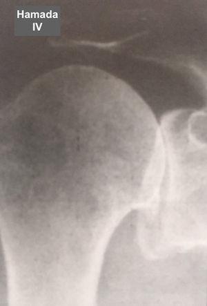 Roturas completas del manguito de los rotadores. Clasificación del ...