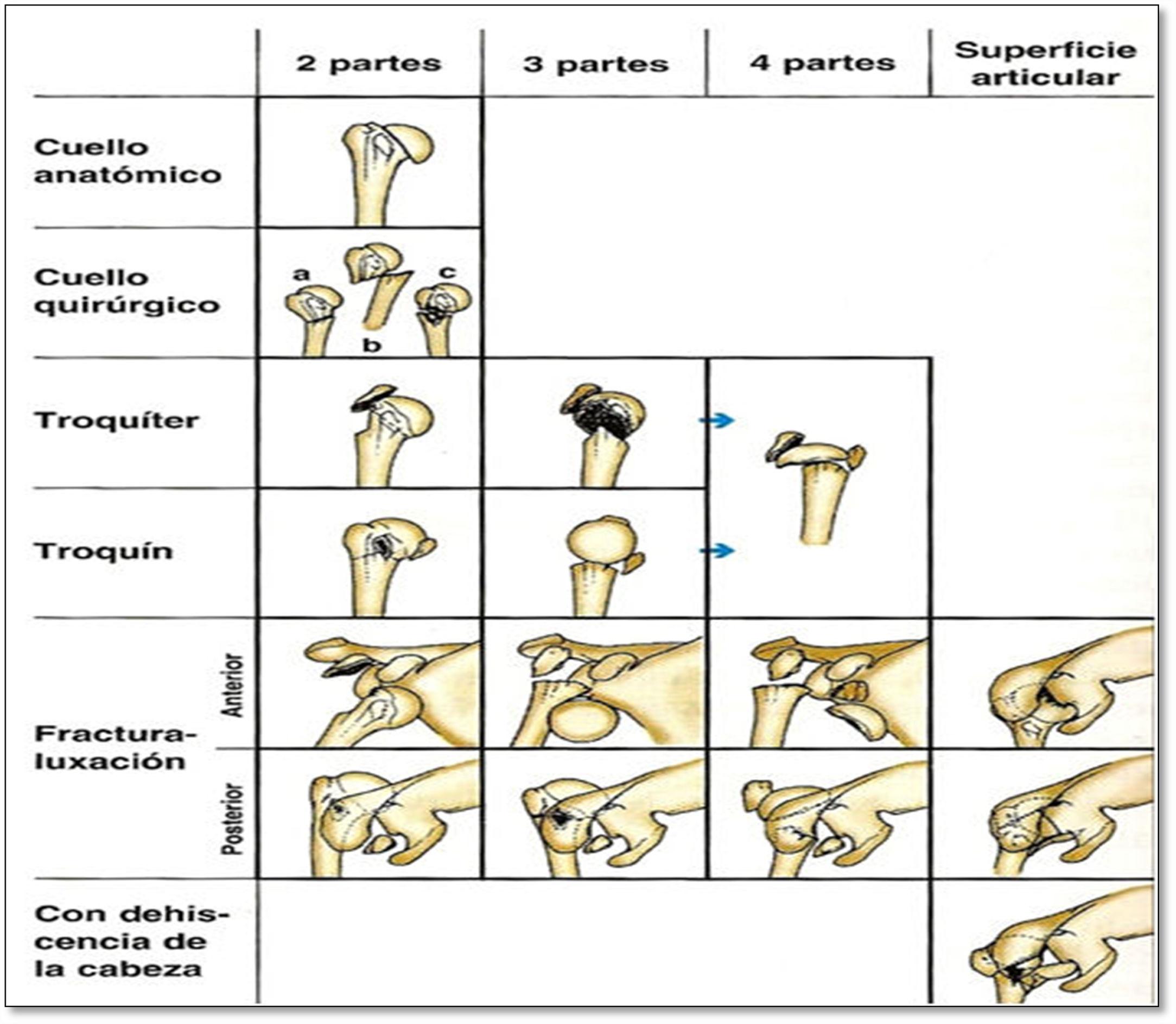 Clasificación de Neer. Variabilidad interobservador | Revista ...