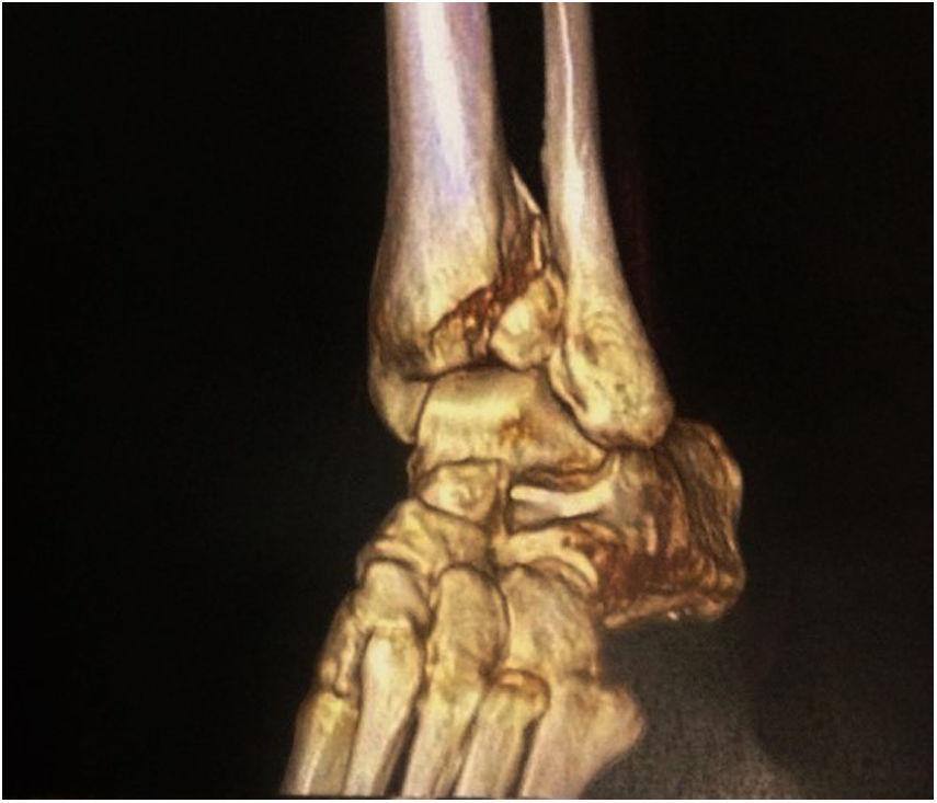 Fractura de Tillaux en adultos en asociación con las fracturas de ...