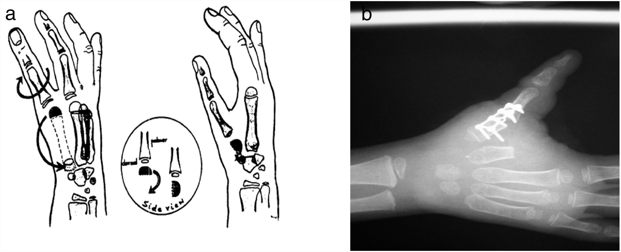 Pulgarización del índice en amputación traumática de pulgar mediante ...
