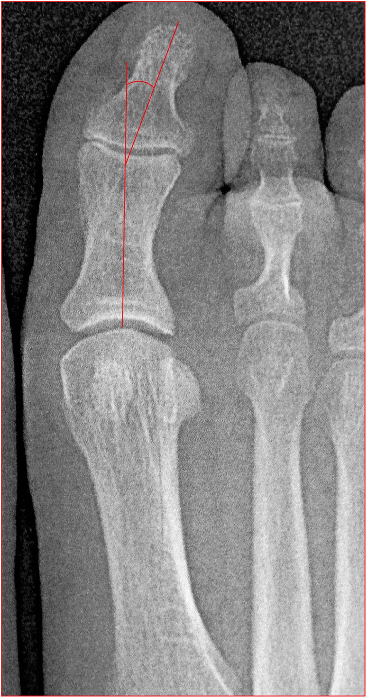 Etiologia y fisopatologia del hallux valgus | Revista Colombiana de ...
