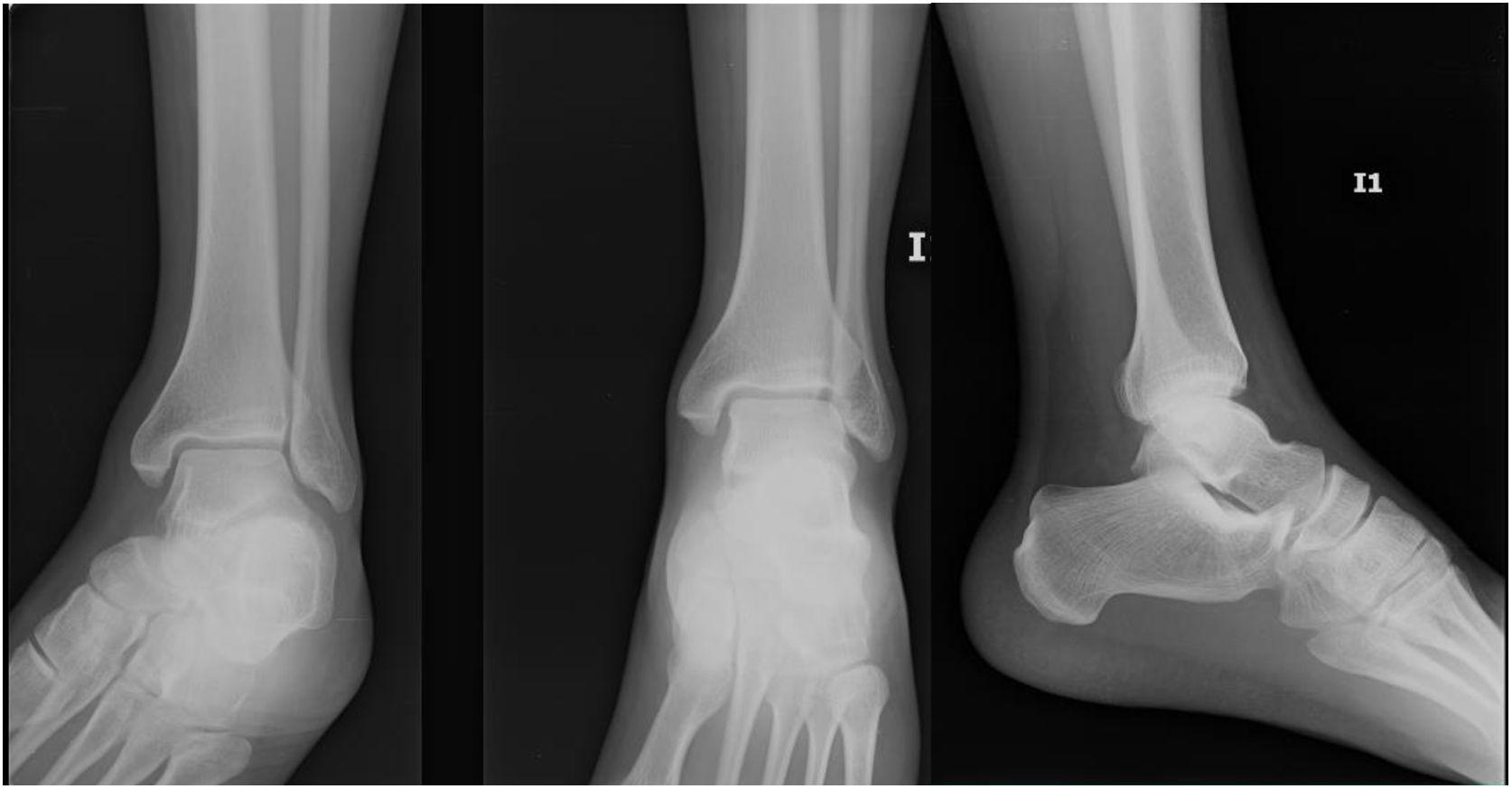 Normal Left Ankle Xray
