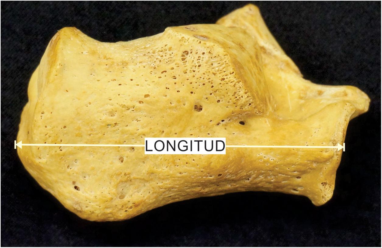Biometría del calcáneo en beneficio de la técnica quirúrgica: estudio ...