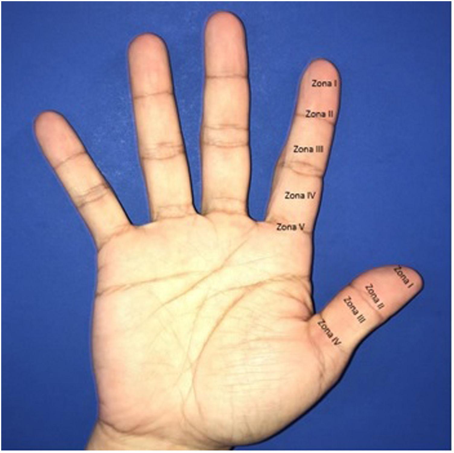 Revascularización y reimplante digital. Revisión de conceptos actuales ...