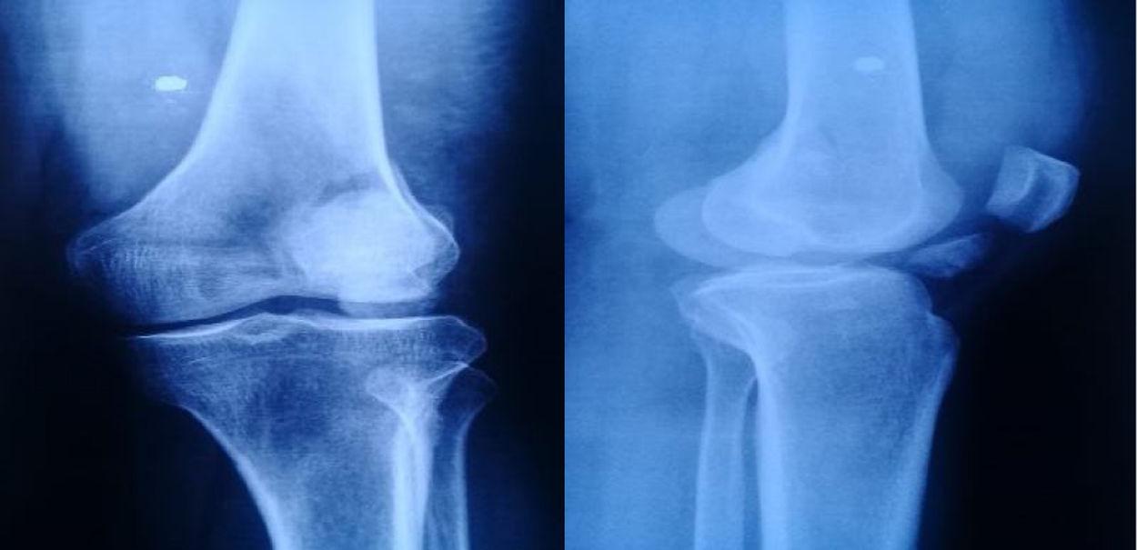 Fractura de Hoffa en el cóndilo femoral. Reporte de caso | Revista ...