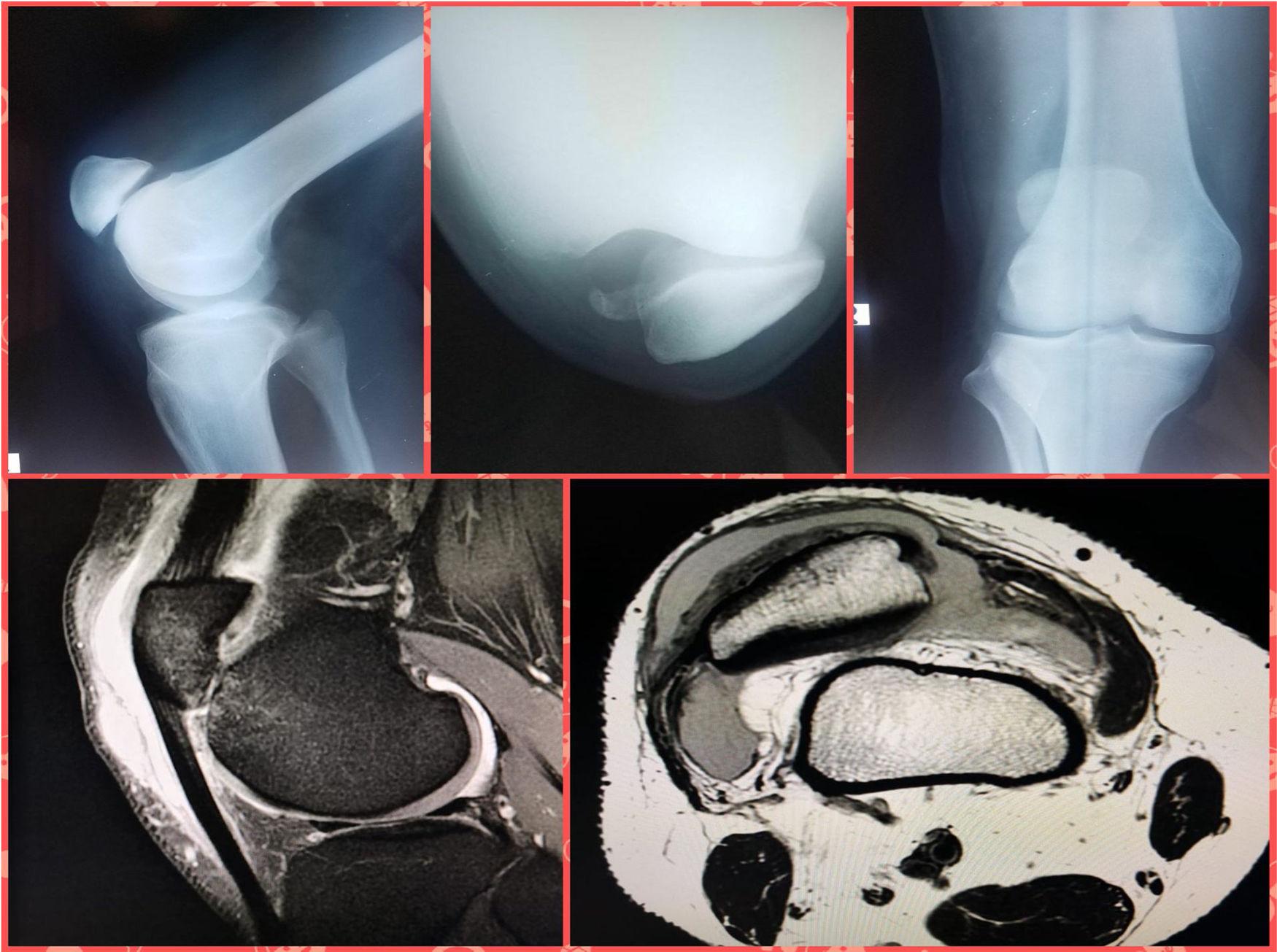 Reconstrucción de Ligamento Patelofemoral Medial en Luxación ...