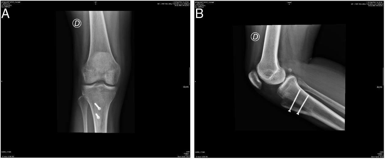 Osteotomía de Fulkerson modificada por Heatley para tratamiento del ...