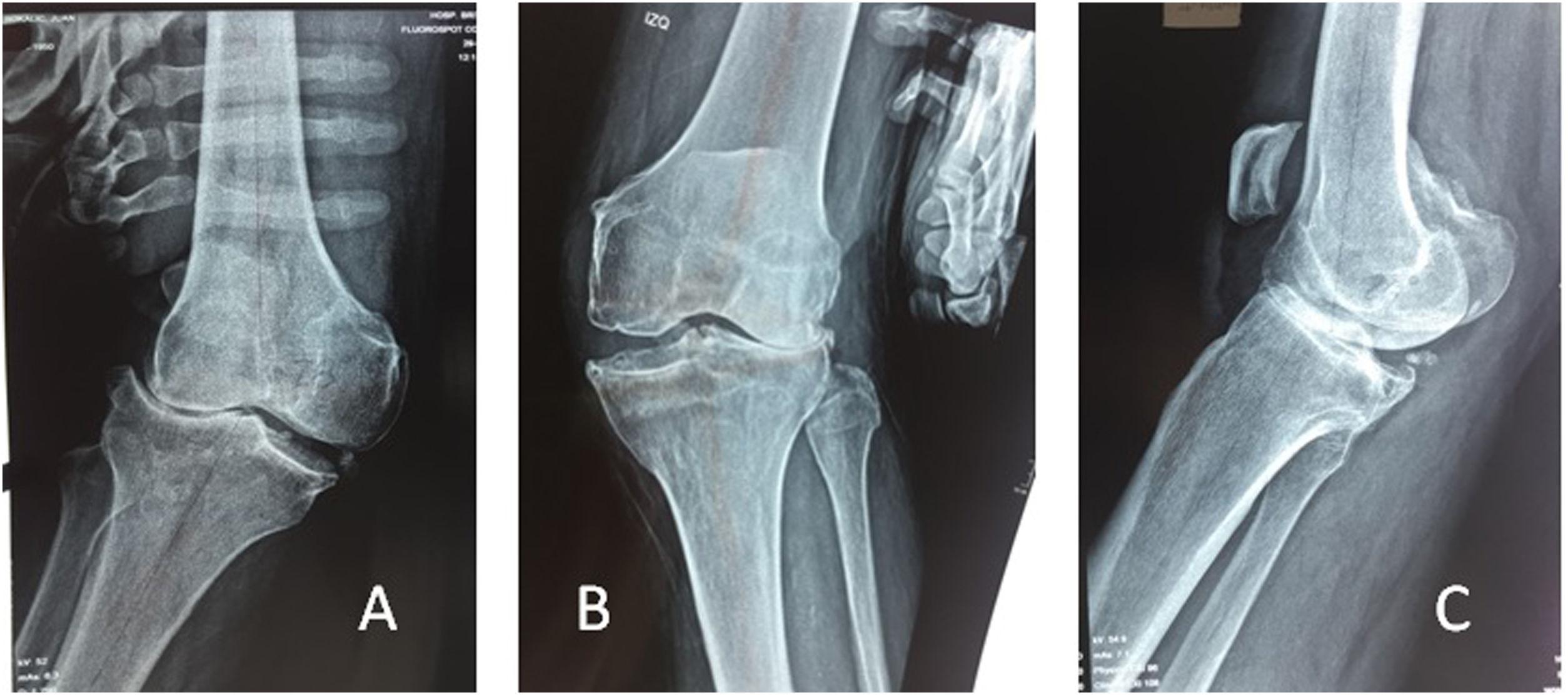 Genu valgo artrósico severo: Prótesis de estabilidad aumentada en ...