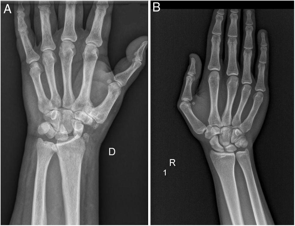 Variabilidad intraobservador e interobservador de las líneas de Gilula ...