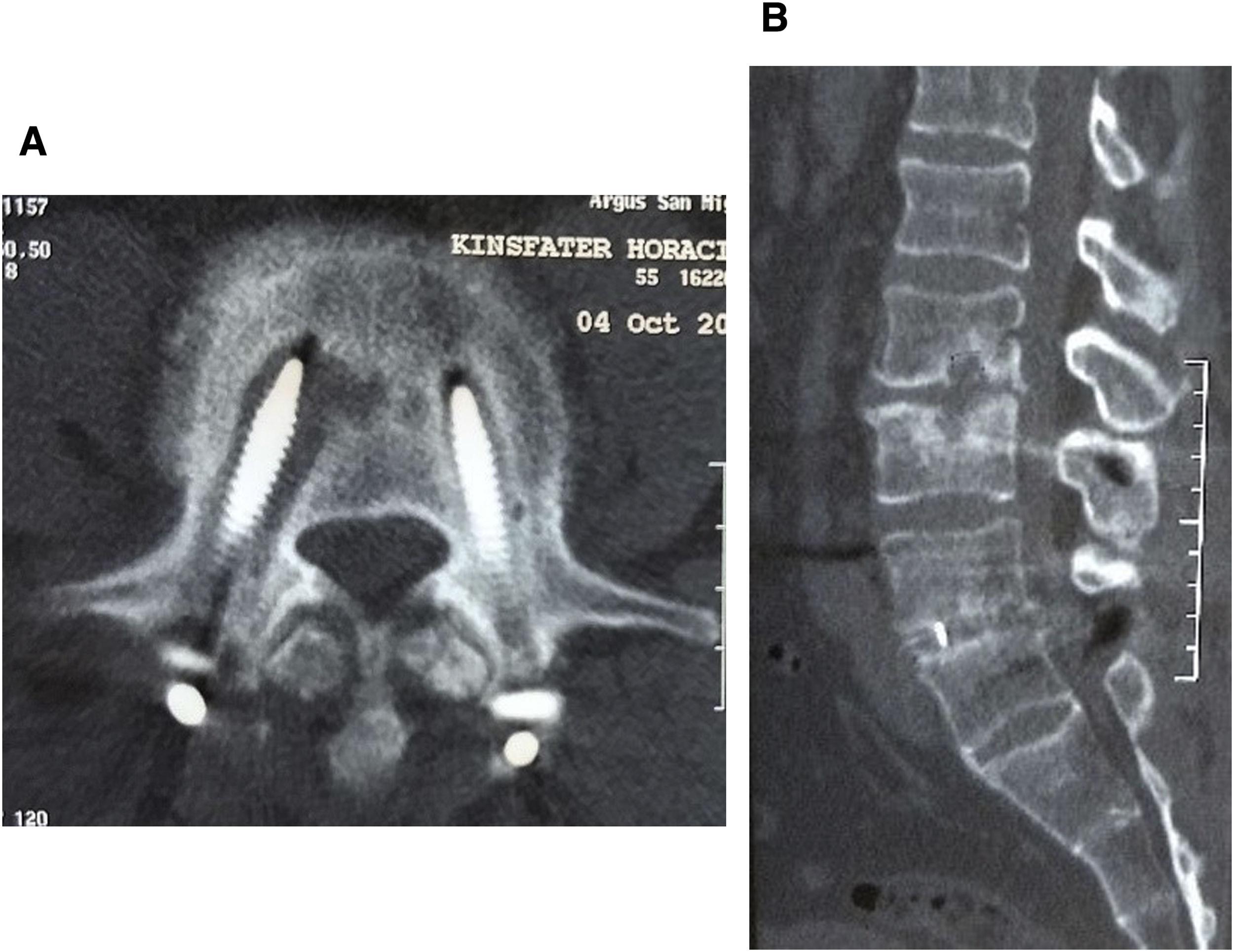 Espondilodiscitis y absceso epidural por Chryseobacterium indologenes ...