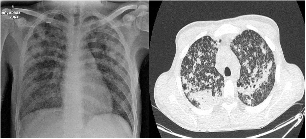 Artritis tuberculosa de tobillo, a propósito de un caso | Revista ...