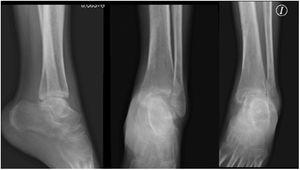 Artritis tuberculosa de tobillo, a propósito de un caso | Revista ...