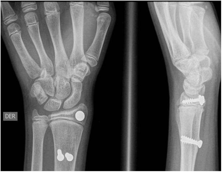 Fractura triplanar del extremo distal del radio: Reporte de caso ...