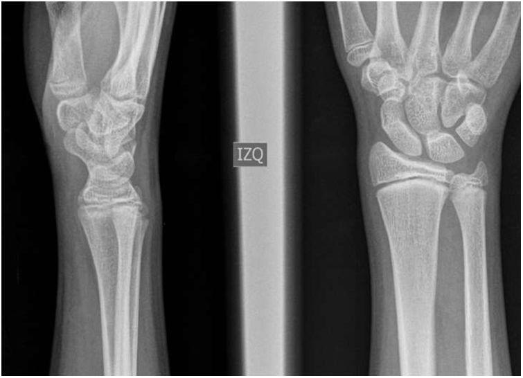 Fractura triplanar del extremo distal del radio: Reporte de caso ...