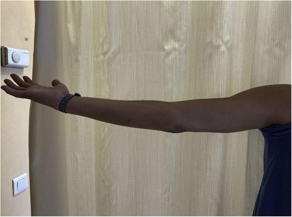 Síndrome compartimental del brazo tras cirugía por fractura ...