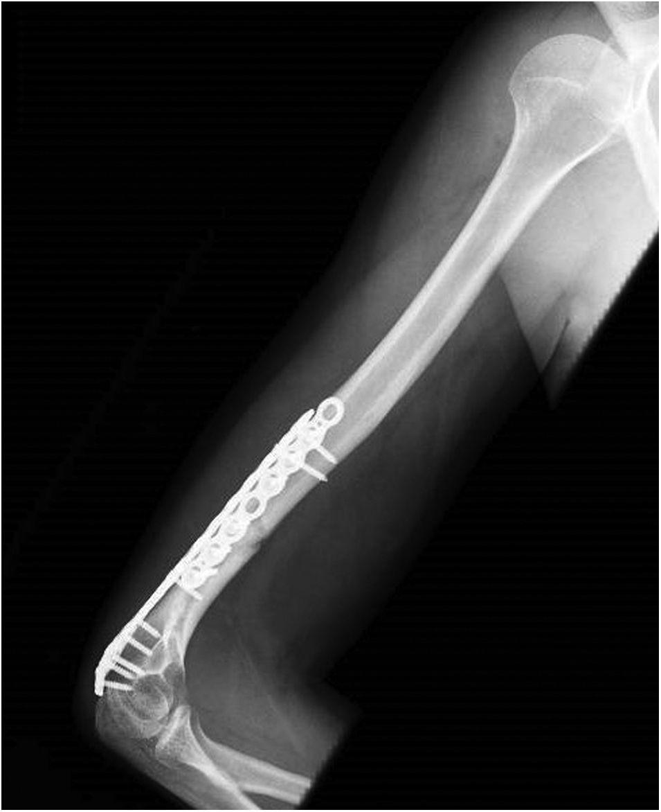 Síndrome compartimental del brazo tras cirugía por fractura ...