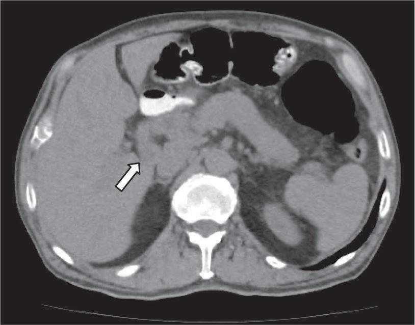 Autoimmune pancreatitis | Revista Colombiana de Reumatología