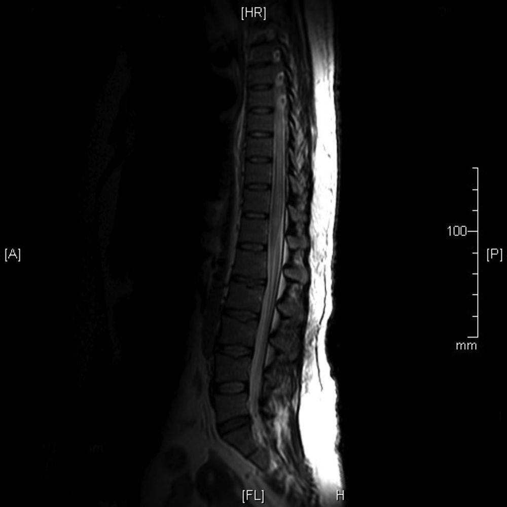 Mielitis longitudinal asociada a lupus eritematoso sistémico | Revista ...
